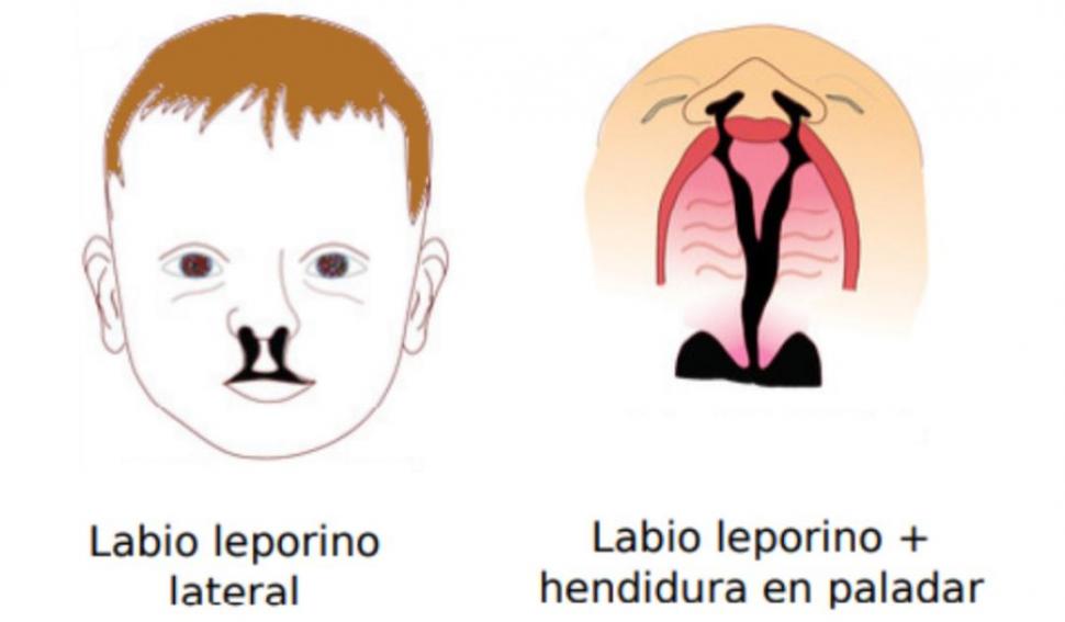 Ciclopia En Humanos Defectos Congénitos: ¿Qué Es La Ciclopía?